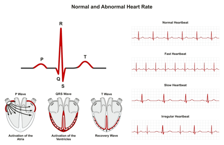 Electrocardiogram (EKG or ECG) Tests: Purpose, Types & Risks